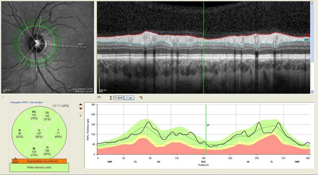 Imaging and Treatment | Capital Eye Specialists